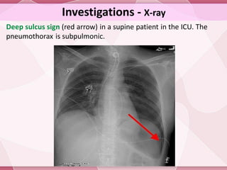 Pneumothoraxandpneumomediastinum 160830234614 (1) | PDF