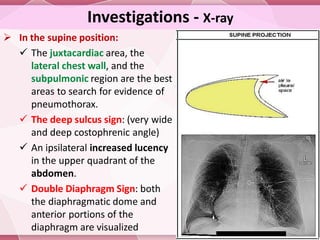 Pneumothorax and Pneumomediastinum...... | PDF