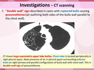 Pneumothorax and Pneumomediastinum...... | PDF
