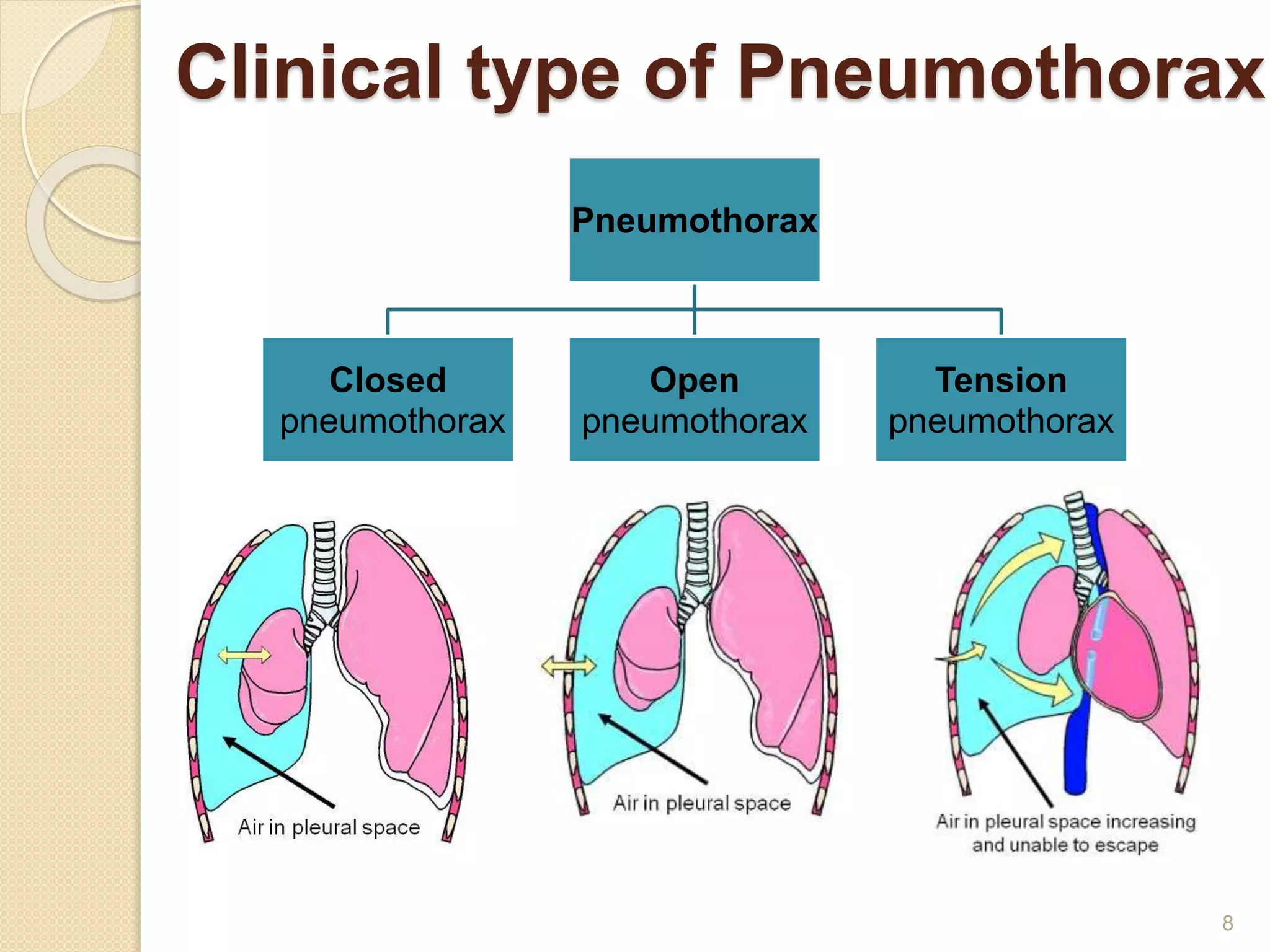Pneumothorax by DJ | PPTX