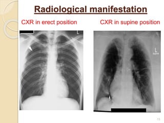 Pneumothorax by DJ | PPTX