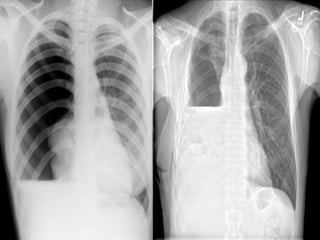 Pneumothorax & chest tube final year mbbs lecture | PPT