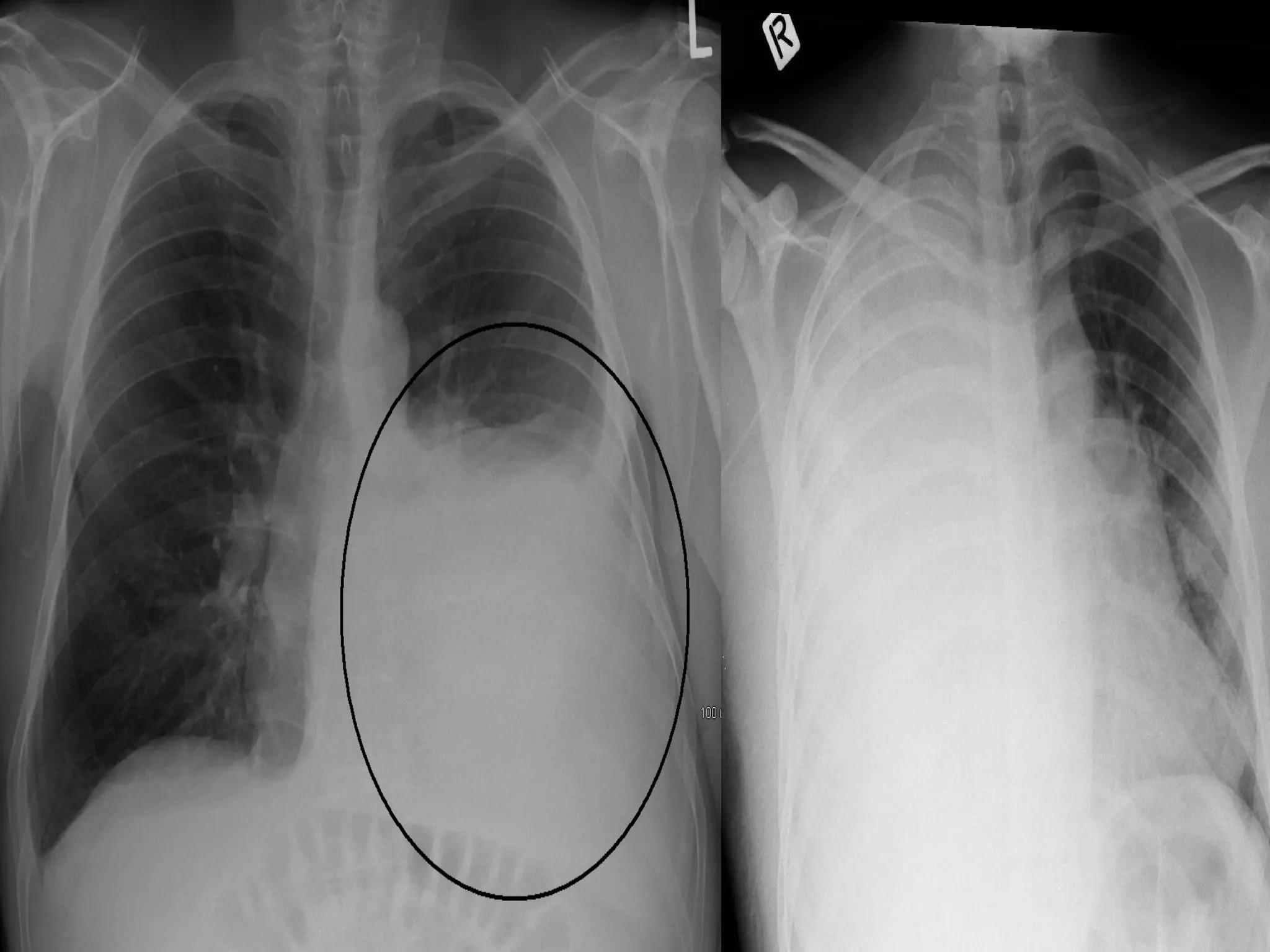 Pneumothorax & chest tube final year mbbs lecture | PPT