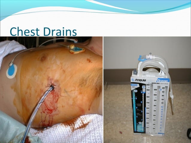 Pneumothorax & chest tube final year mbbs lecture | PPT | Lung and ...