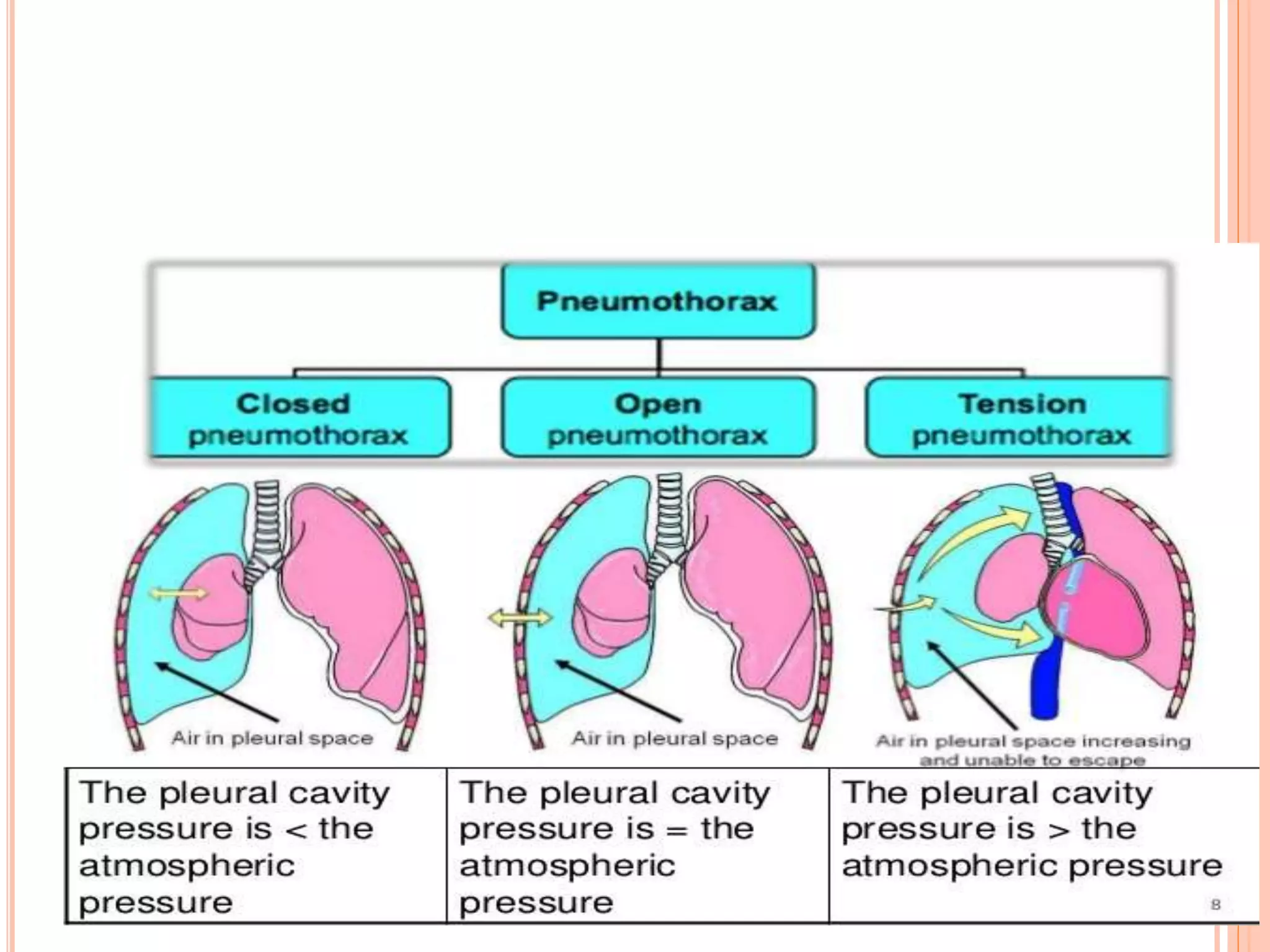 Pneumothorax case presentation | PPTX