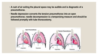 PNEUMOTHORAX Forensic Medicine.pptx