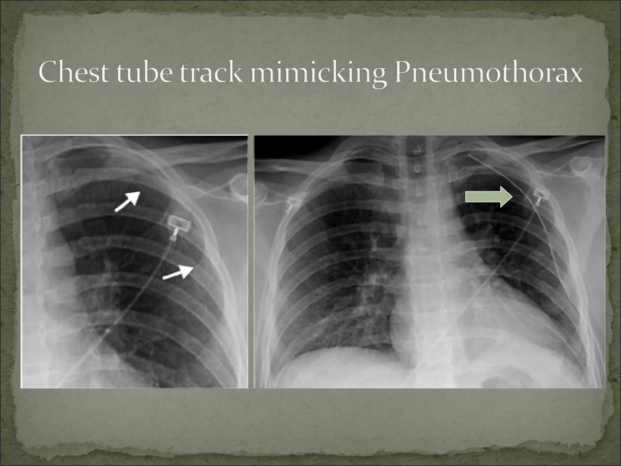 Pneumothorax class | PPT