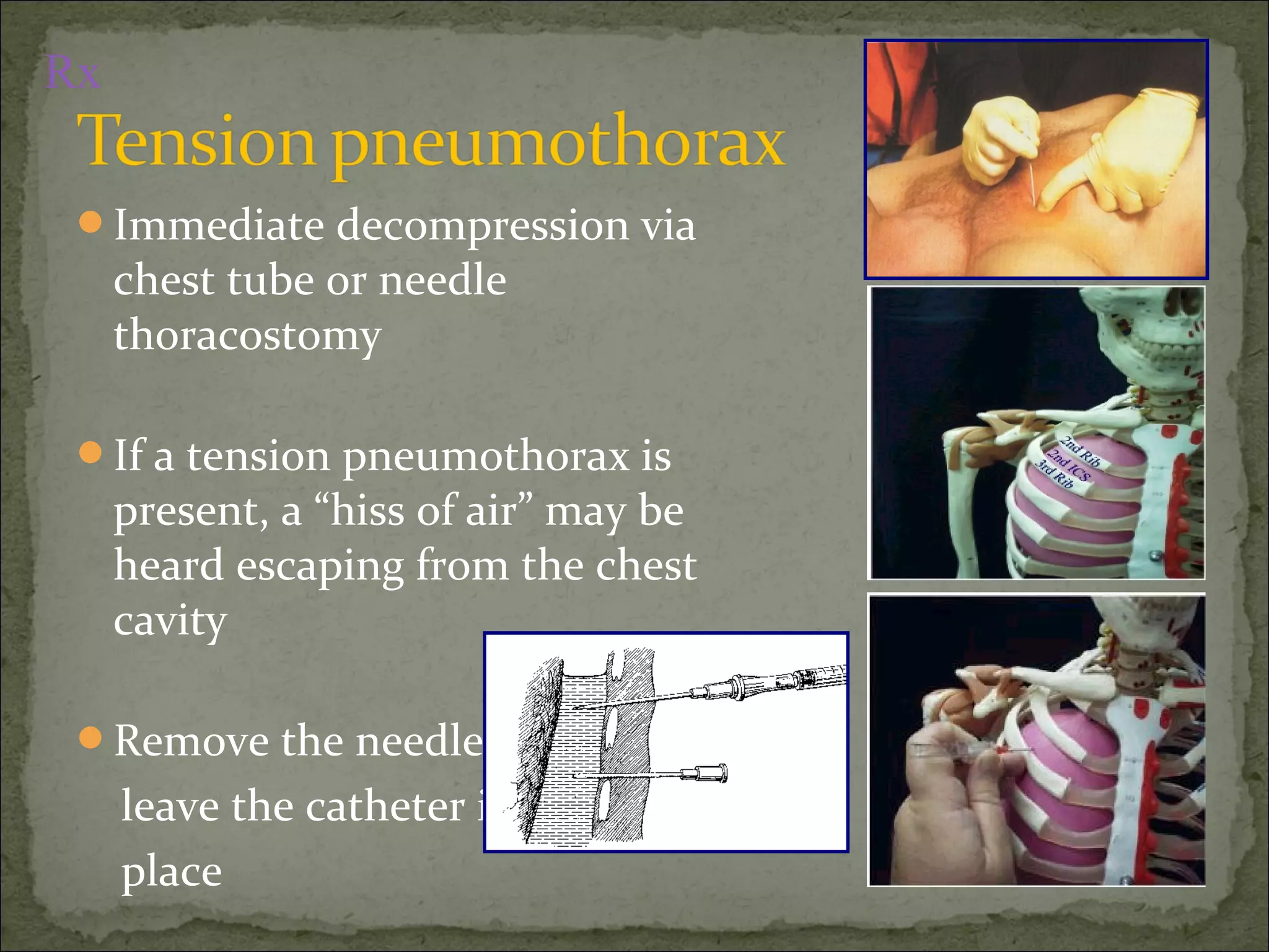 Pneumothorax class | PPT