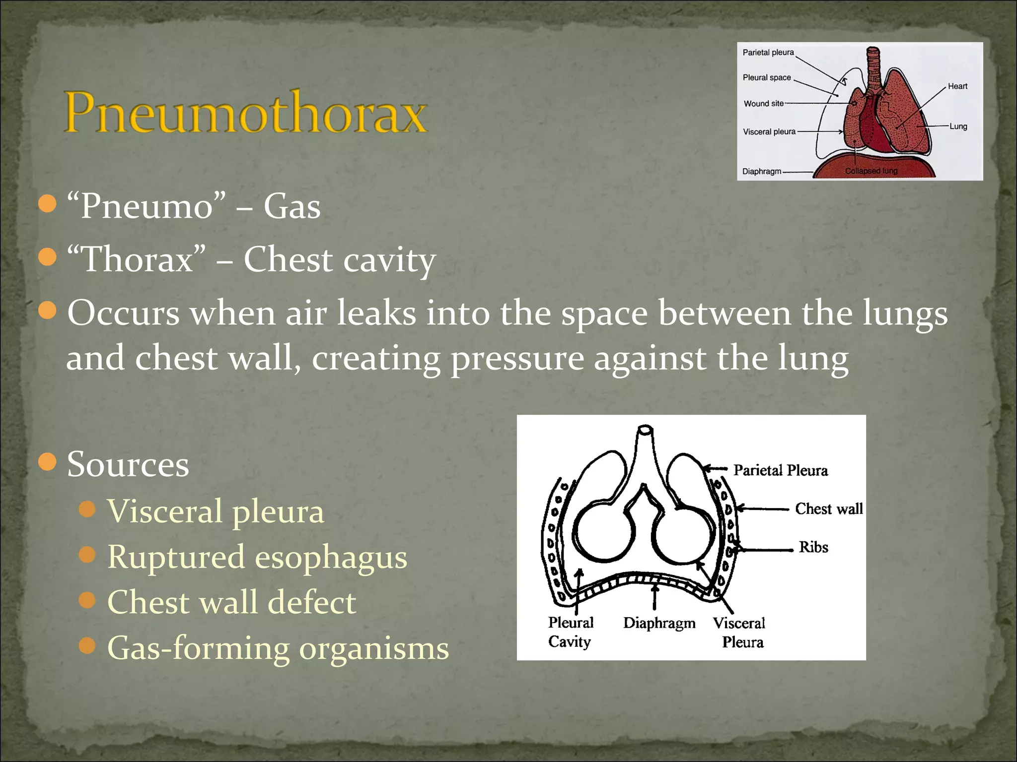 Pneumothorax class | PPT