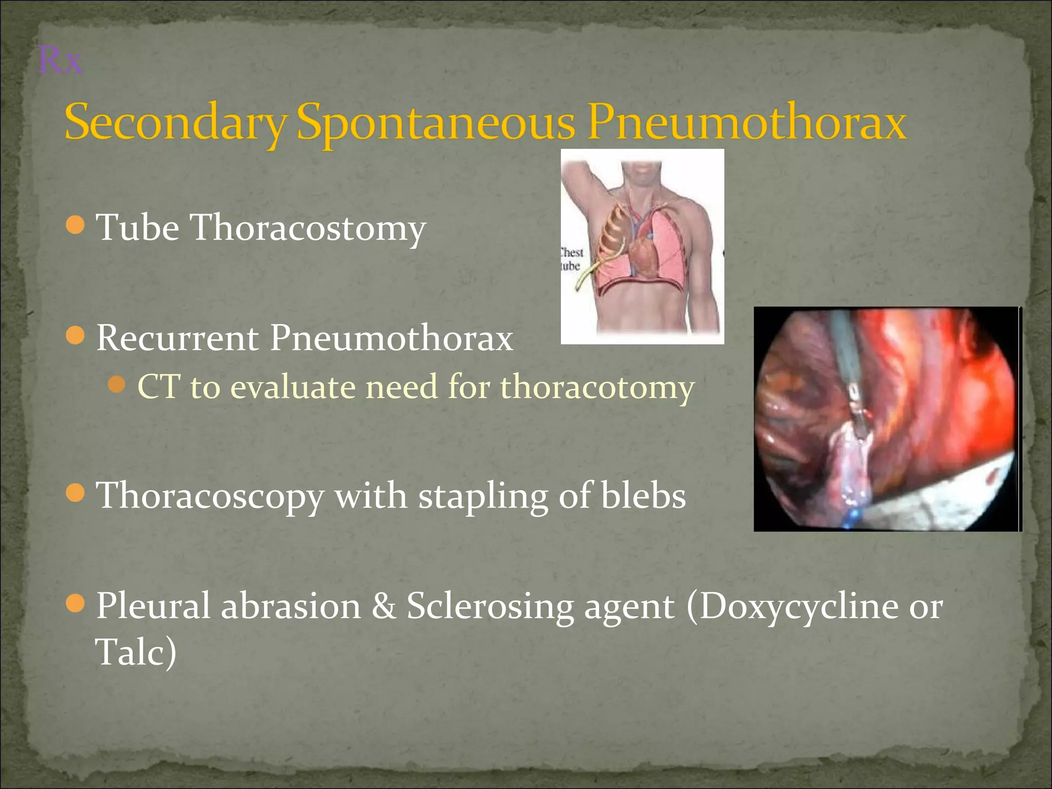 Pneumothorax class | PPT