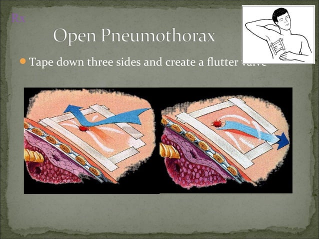 Pneumothorax class | PPT