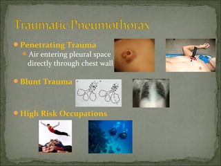 Pneumothorax class | PPT