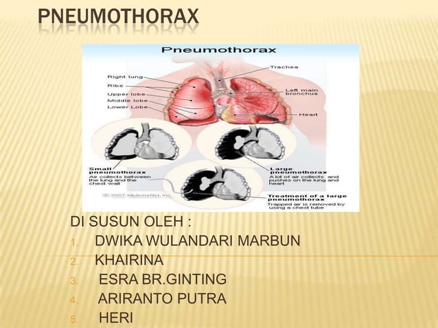Pneumothorax powerpoint | PPTX