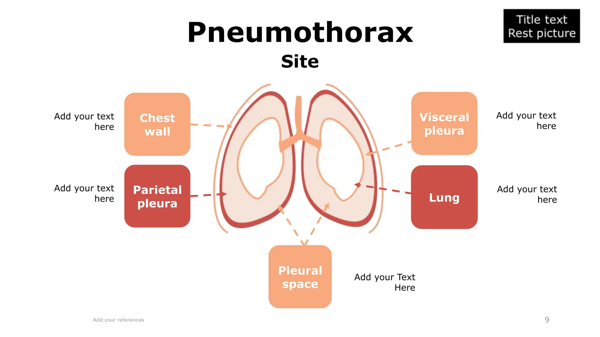 Pneumothorax PowerPoint Template.pptx