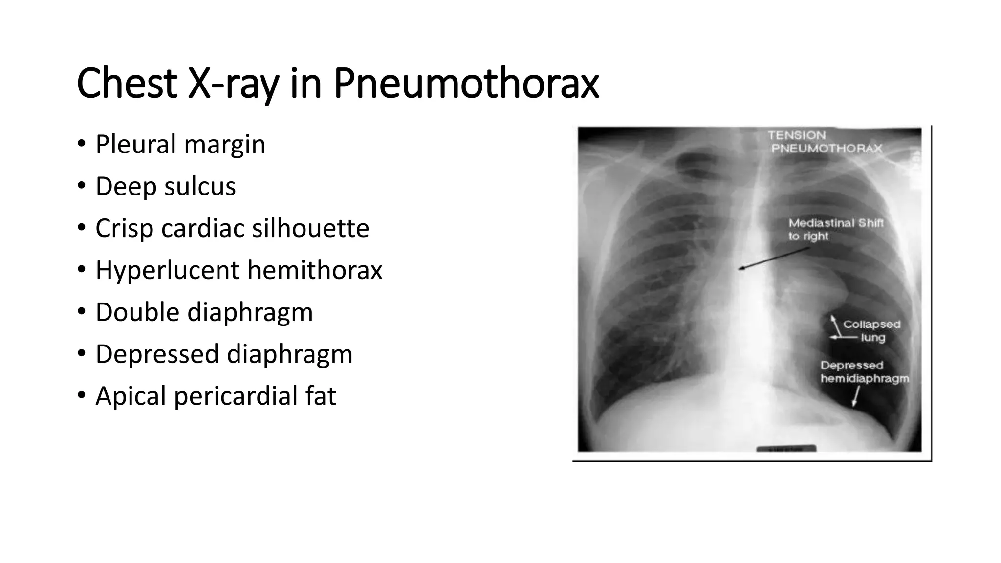 Pneumothorax : Cause and management | PPTX