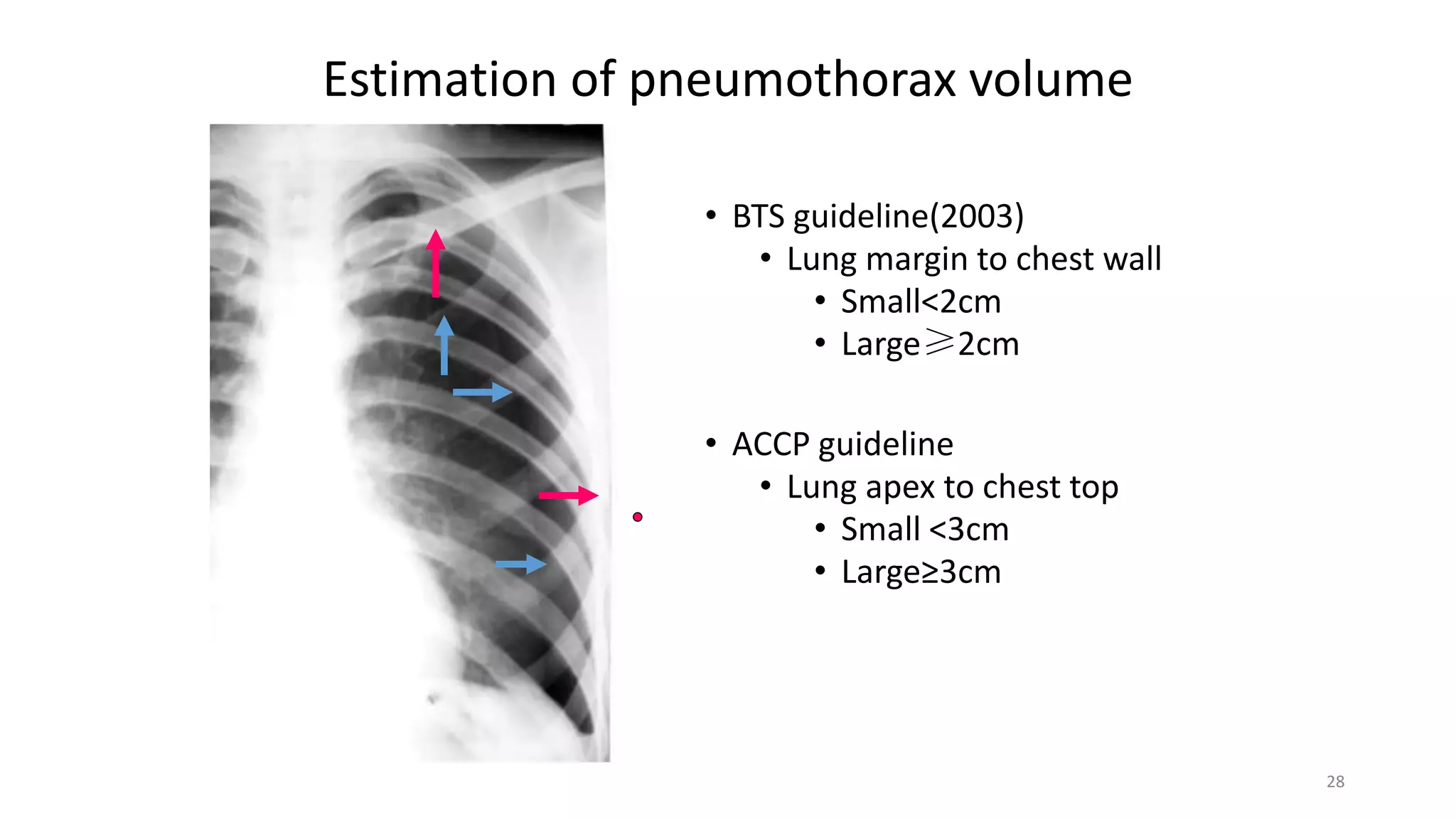 Pneumothorax : Cause and management | PPTX