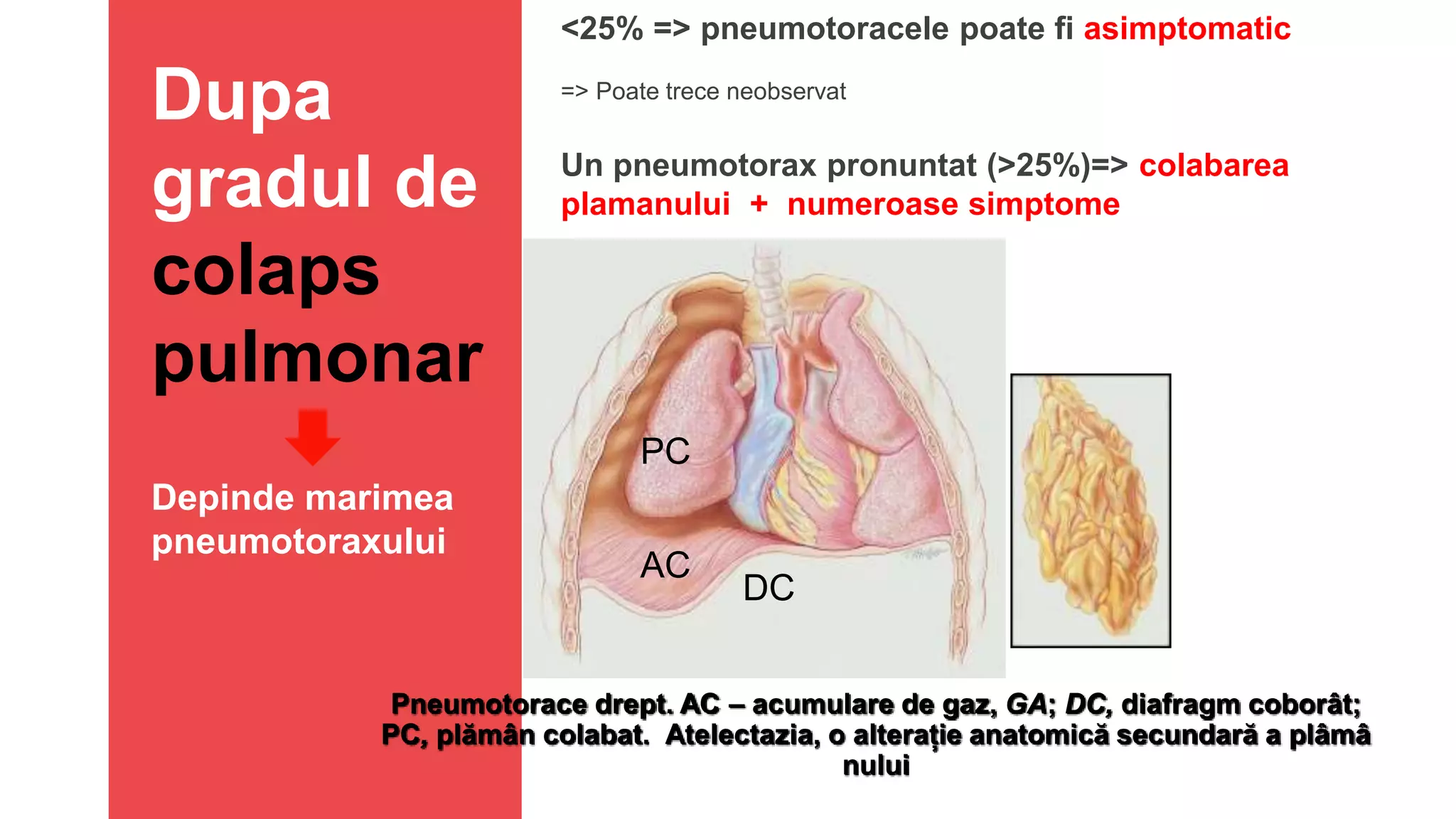 Pneumotorax | PPTX