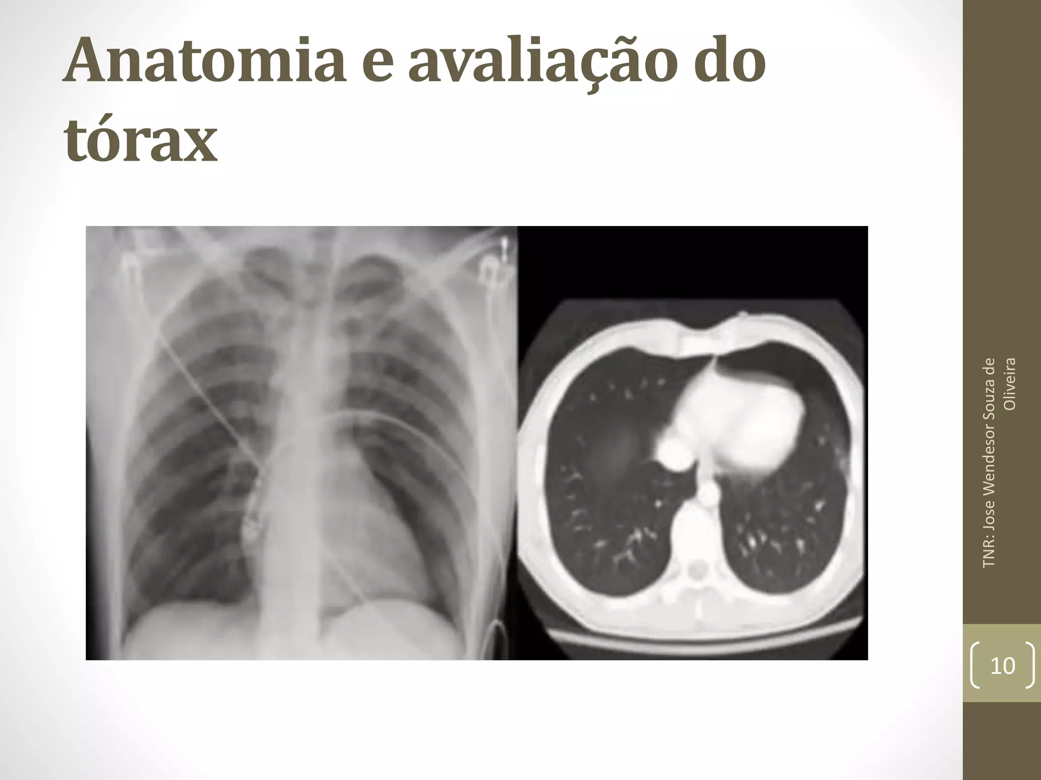 Anatomia e avaliação do tórax em exames radiológicos | PPTX