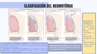 Pneumotorax | PPTX