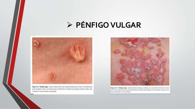 Pénfigo