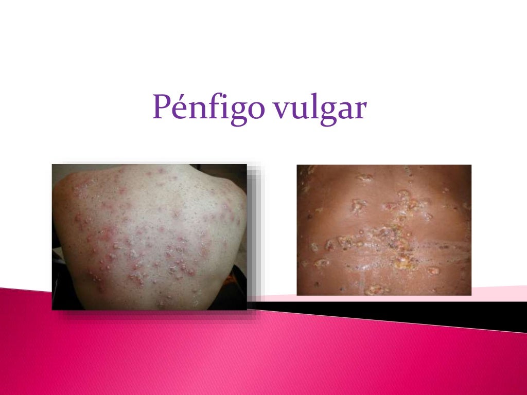 Pénfigo vulgar