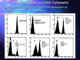 Anaemia PNH | PPT