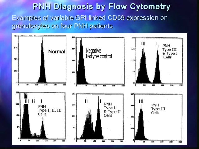 Anaemia PNH