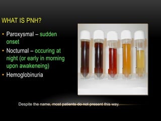Paroxysmal Nocturnal Hemoglobinuria Urine