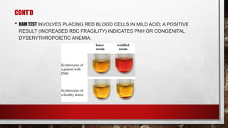 Paroxymal nocturnal hemoglobinuria | PPTX | Blood Disorders | Diseases ...