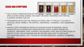 Paroxymal nocturnal hemoglobinuria | PPTX