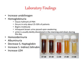 Paroxysmal Nocturnal Hemoglobinuria Urine