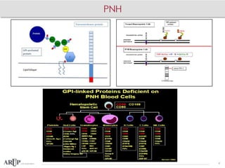 Paroxysmal Nocturnal Hemoglobinuria hematology aspect | PPT