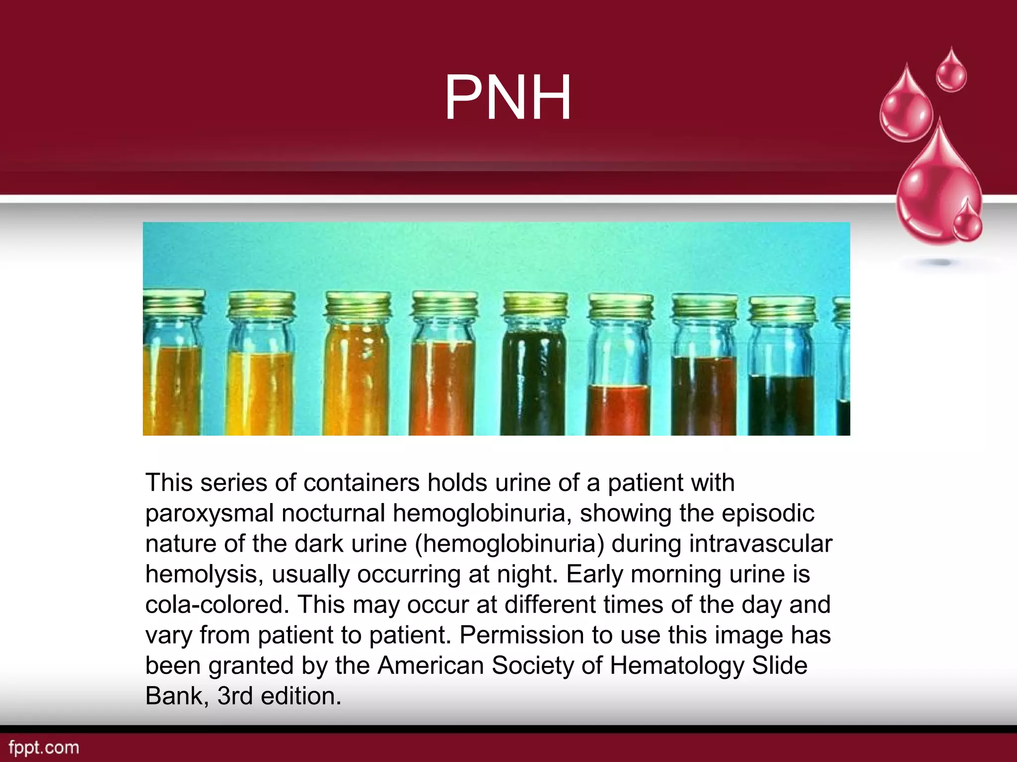 Paroxymal Nocturnal HemoglobinurIa | PPT