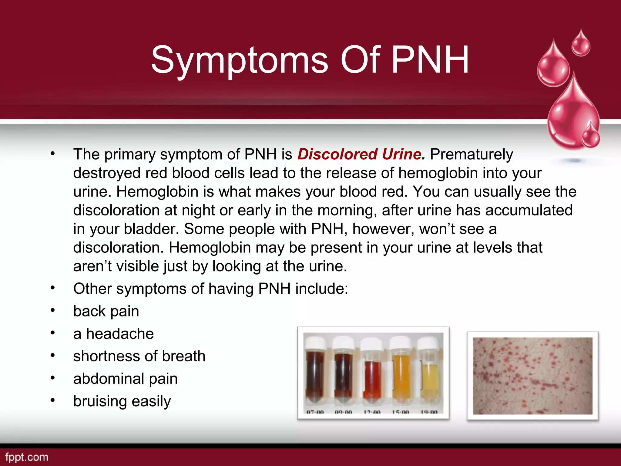 Paroxymal Nocturnal HemoglobinurIa | PPT