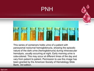 Paroxysmal Nocturnal Hemoglobinuria Urine