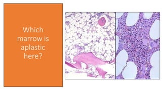 PNH Overview Prof Maamoun AlSermani Saudi Arabia.pptx