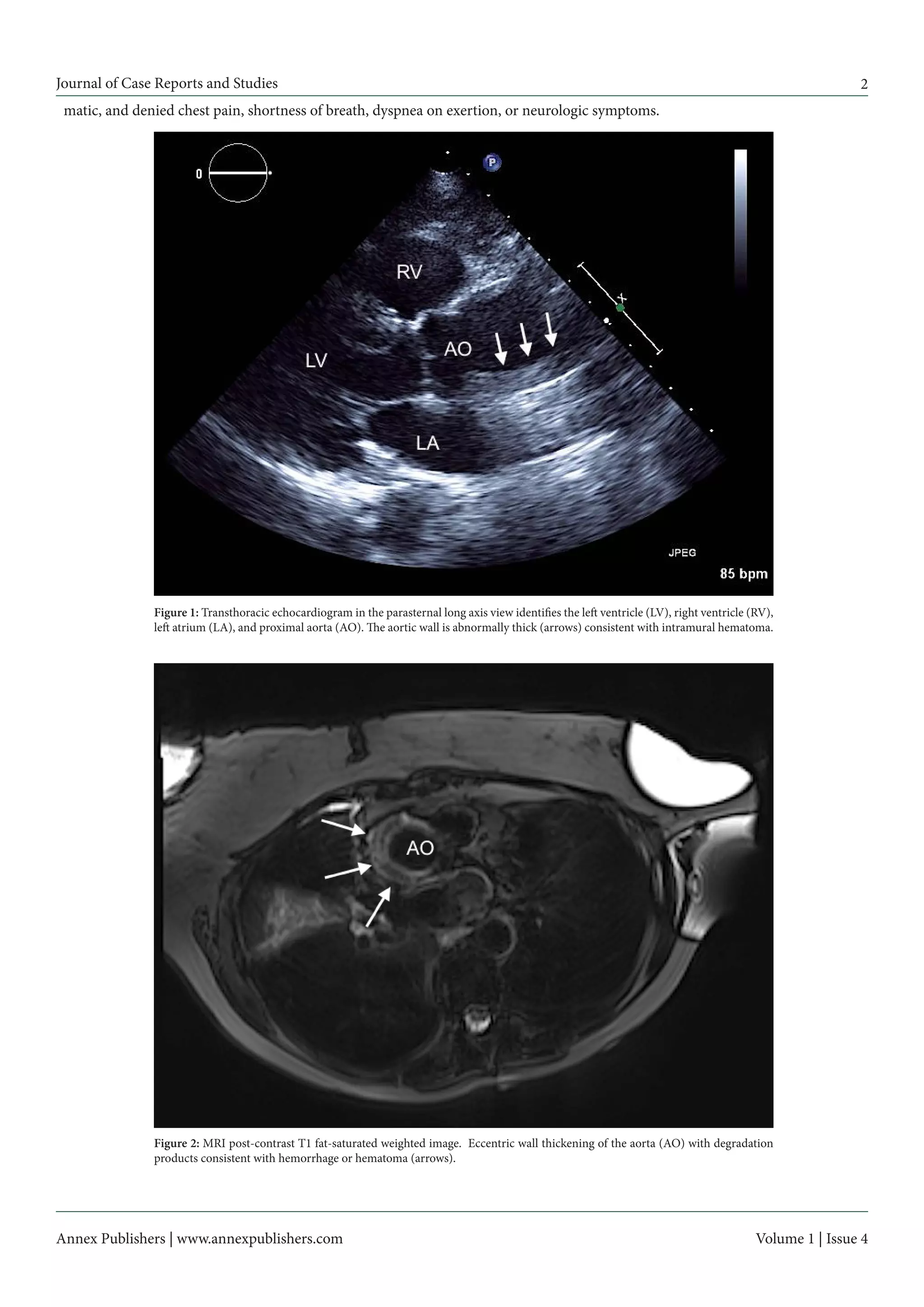 Ascending aortic-b-cell-lymphoma-masquerading-as-intramural-hematoma-a ...