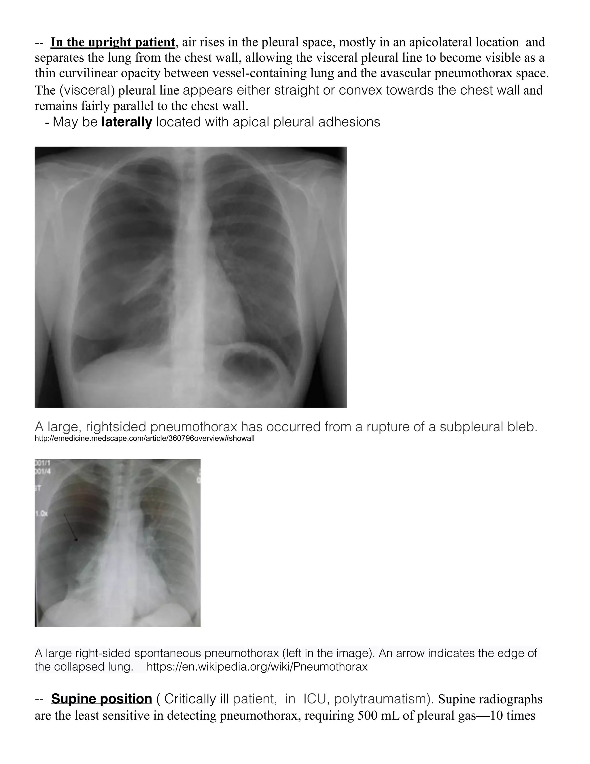 Walif Chbeir: Medical Imaging of PneumoThorax (PNO)–2 | PDF