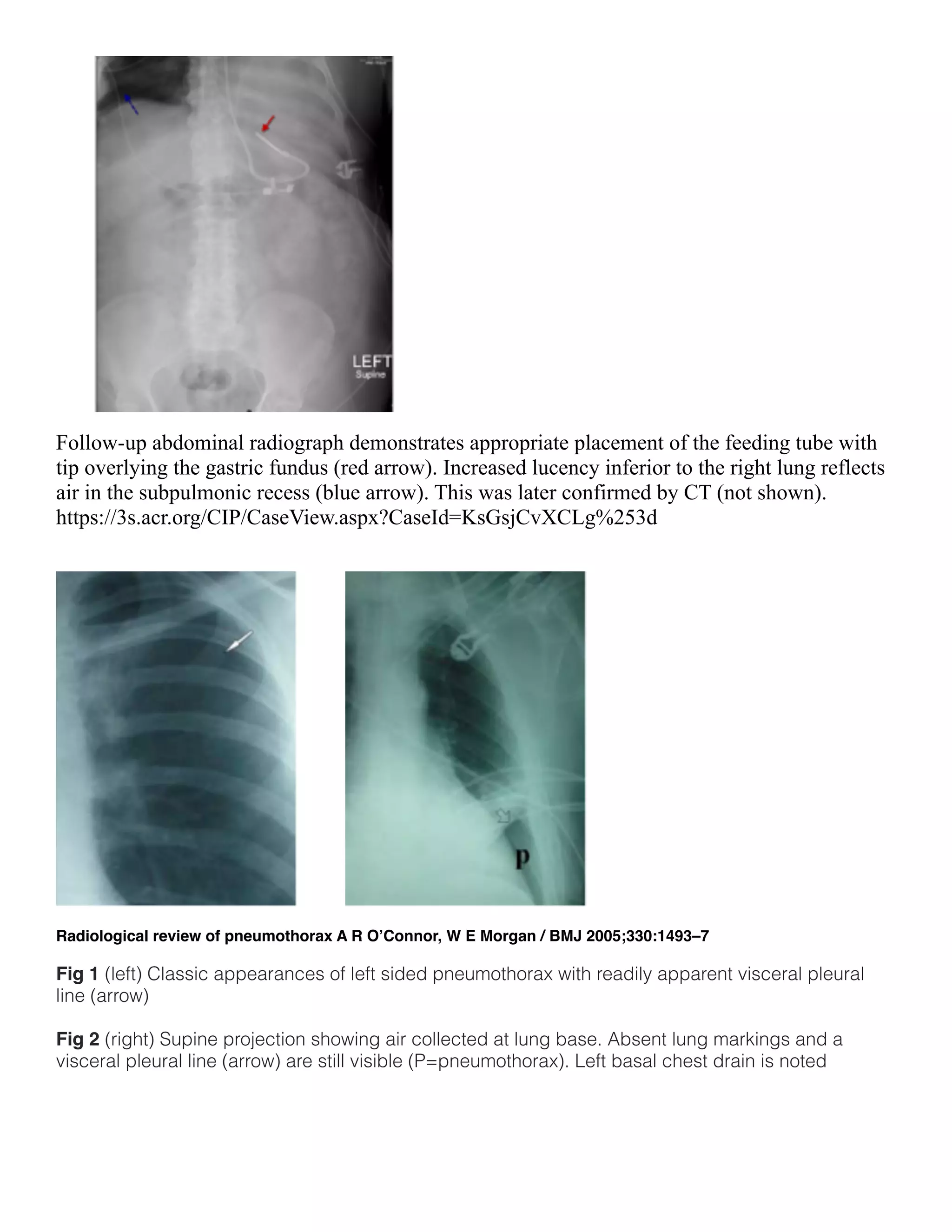 Walif Chbeir: Medical Imaging of PneumoThorax (PNO)–2 | PDF