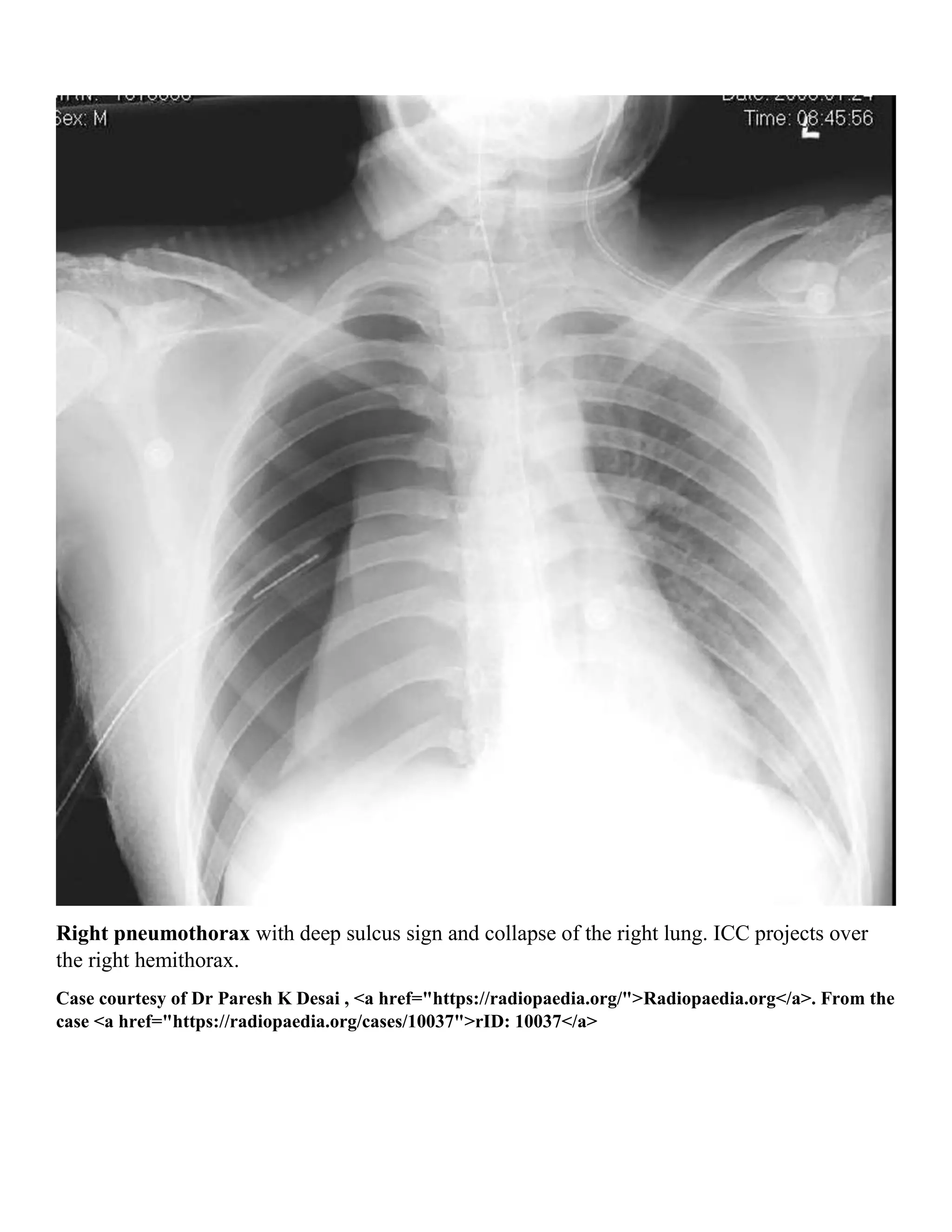 Medical Imaging of Pneumothorax (PNO)–FIGURES-Walif Chbeir | PDF