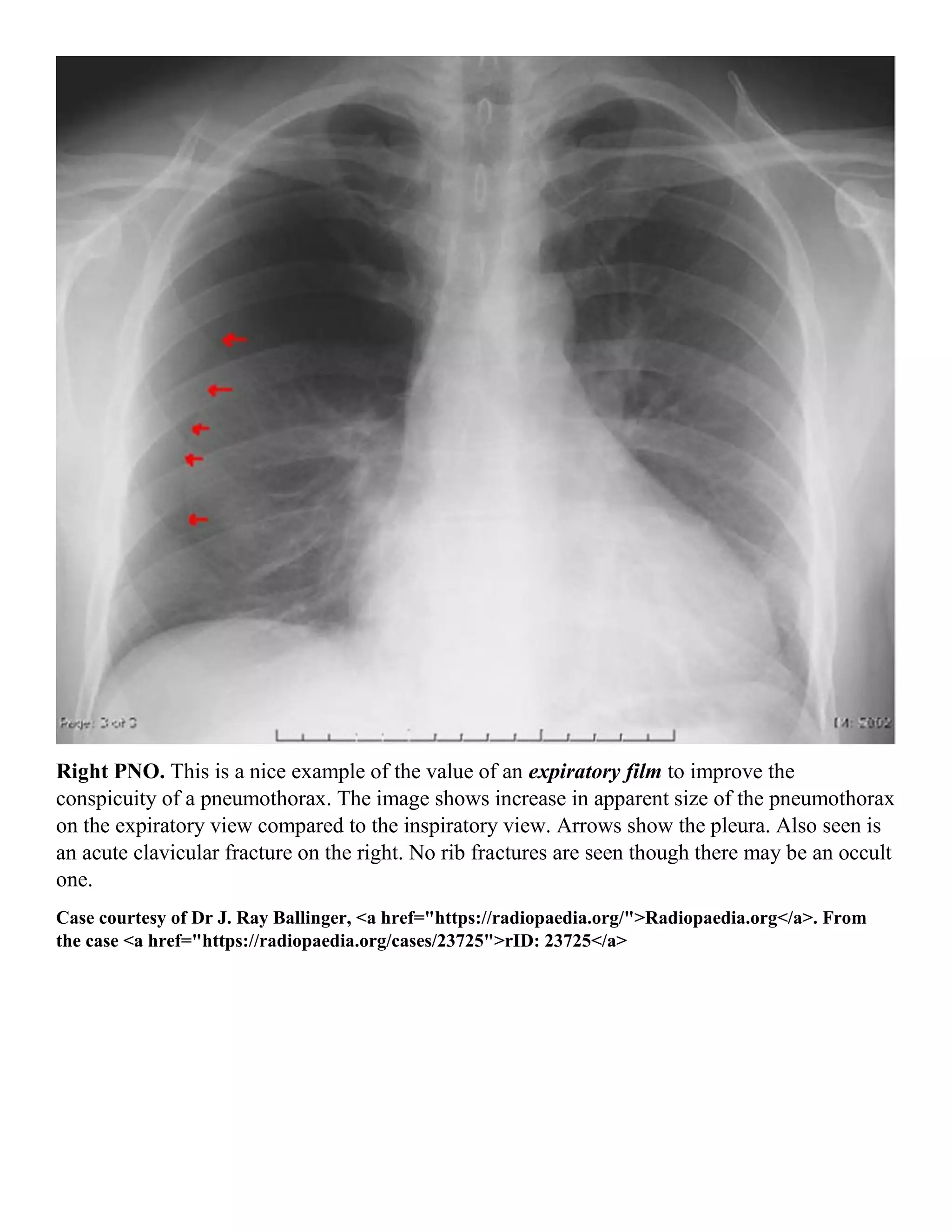 Medical Imaging of Pneumothorax (PNO)–FIGURES-Walif Chbeir | PDF
