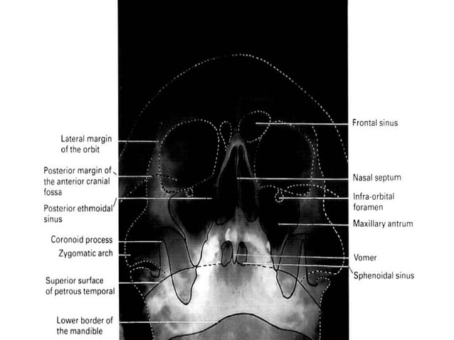 Pns view | PPT | Death, Injury, or Military Conflict | Sensitive Topics