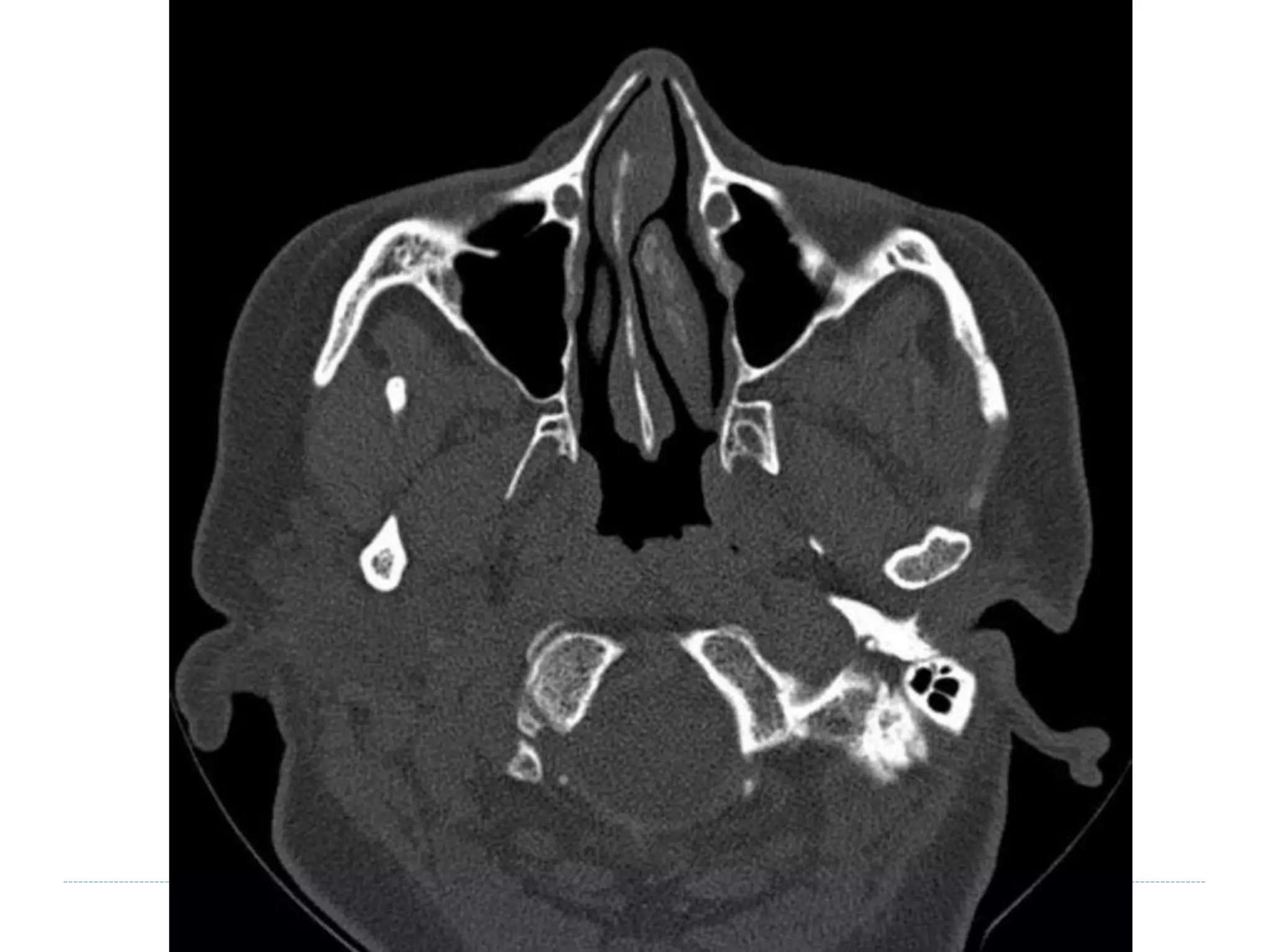 PNS- radiological anatomy (wecompress.com) (1).pptx
