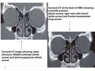 PNS- radiological anatomy (wecompress.com) (1).pptx