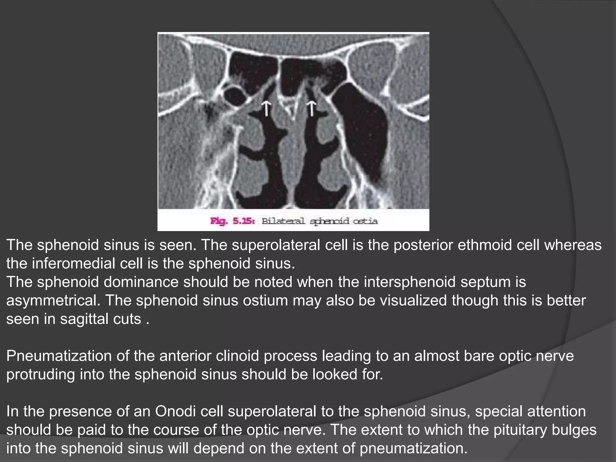 PNS (Para-nasal-sinuses) anatomy and variants | PPTX