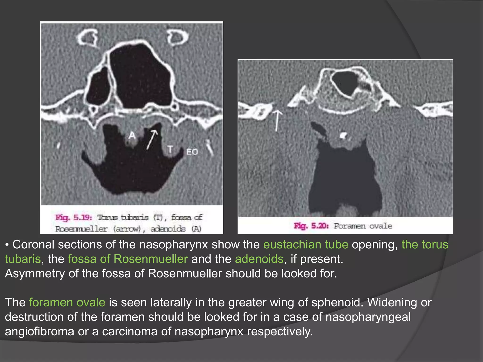 PNS (Para-nasal-sinuses) anatomy and variants | PPTX