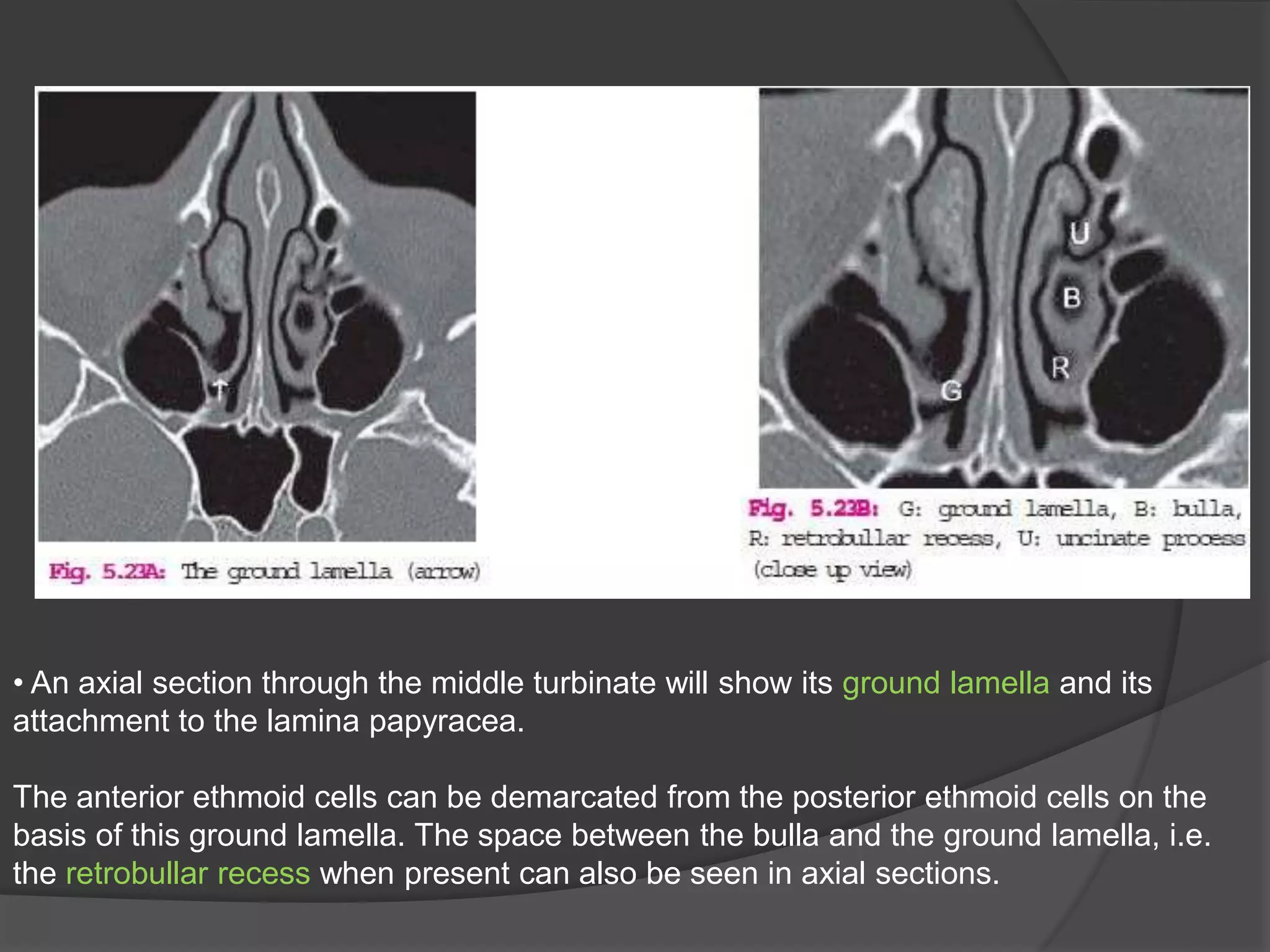 PNS (Para-nasal-sinuses) anatomy and variants | PPTX