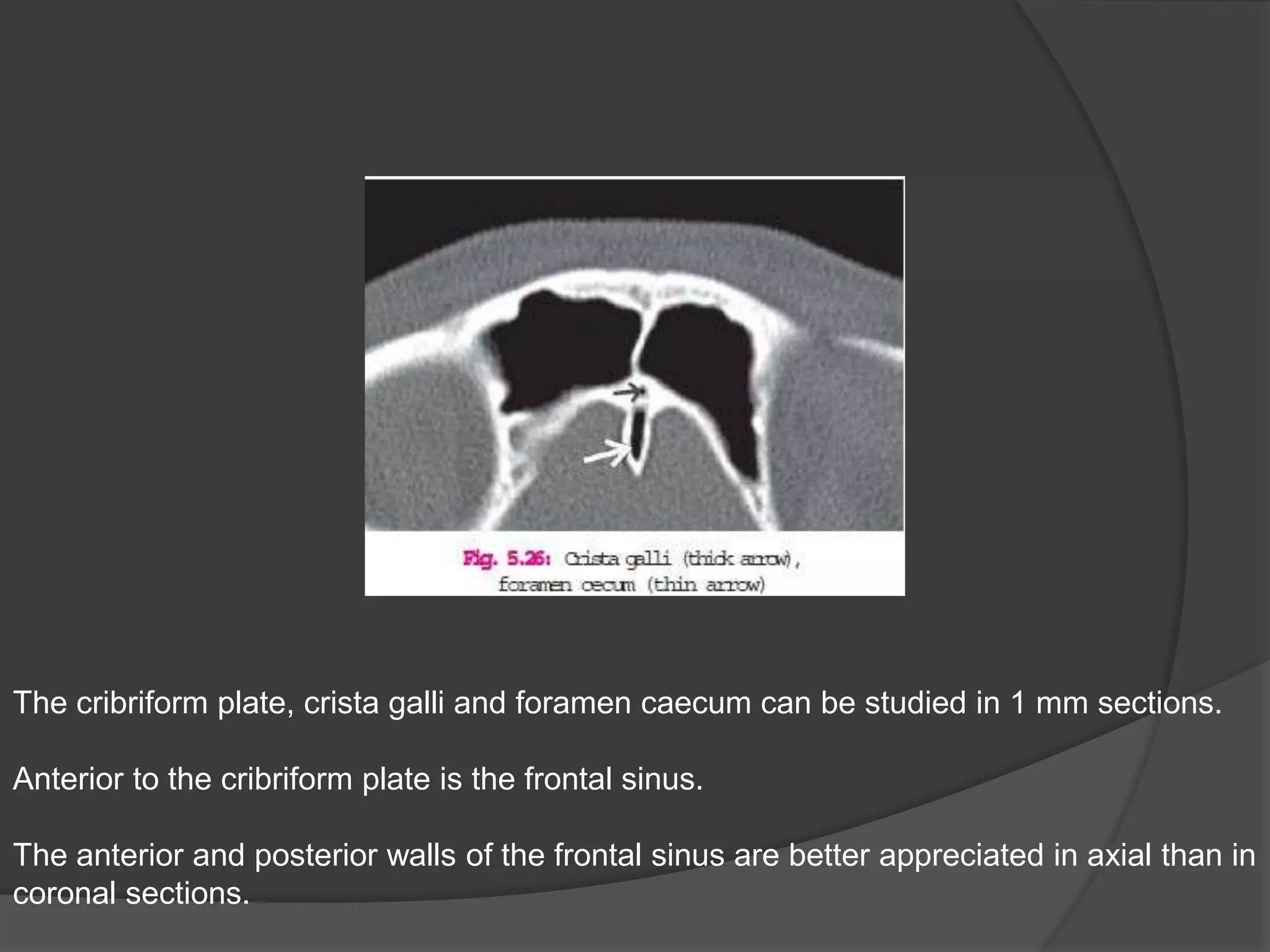 PNS (Para-nasal-sinuses) anatomy and variants | PPTX