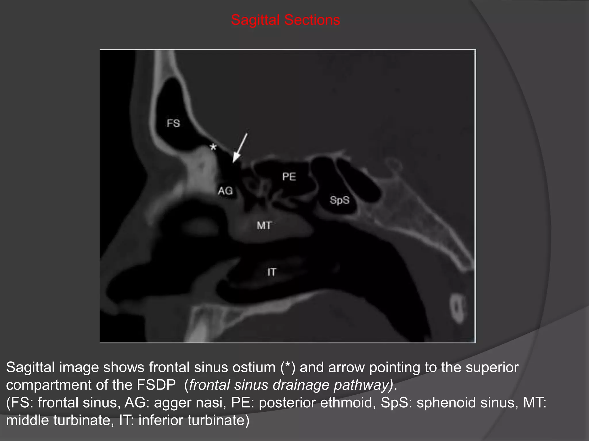 PNS (Para-nasal-sinuses) anatomy and variants | PPTX