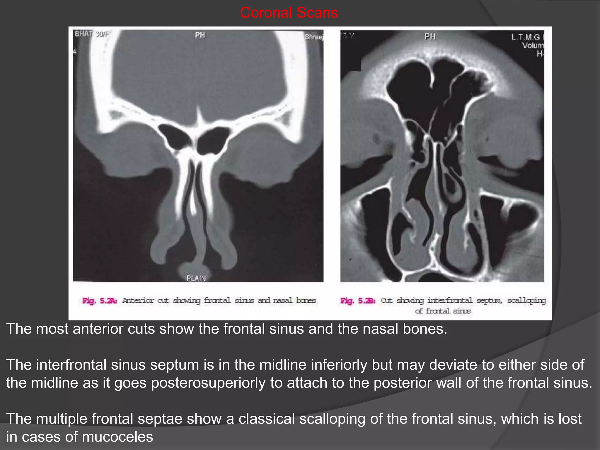 PNS (Para-nasal-sinuses) anatomy and variants | PPTX